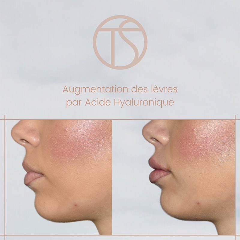 L’acide hyaluronique - Docteur Thomas SORIN | Chirurgie esthétique ...